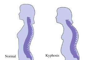 Hyperkyphosis - PTandMe