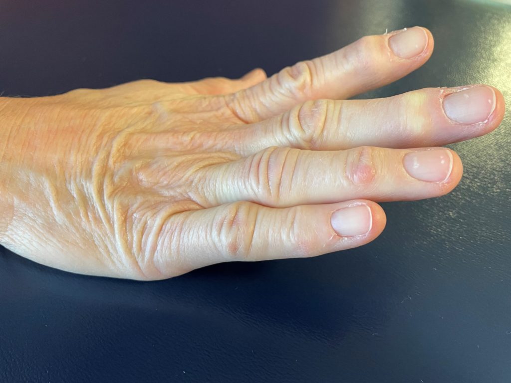How Physical Therapy Can Treat Rheumatoid Arthritis - PTandMe