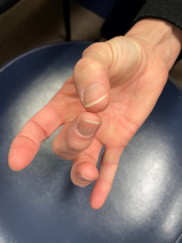 How Physical Therapy Can Treat Rheumatoid Arthritis - PTandMe